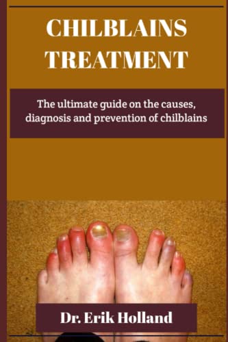 Chilblains: Symptoms, Complications, And Treatment – HXRBF