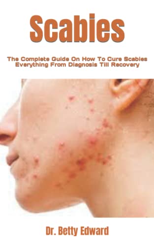 Scabies: The Complete Guide On How To Cure Scabies Everything From ...