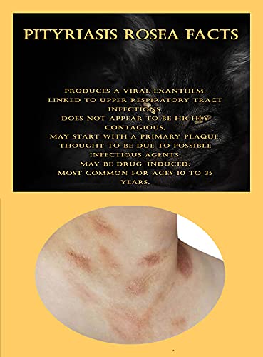 Pityriasis Rosea Facts: Produces A Viral Exanthem, Linked To Upper ...