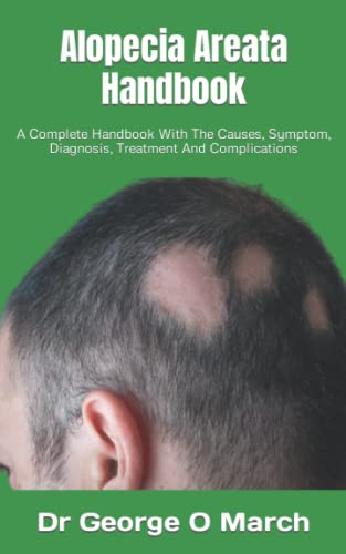 Alopecia Areata Handbook: A Complete Handbook With The Causes, Symptom ...