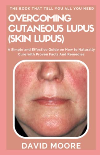 Overcoming Cutaneous Lupus (Skin Lupus): A Simple and Effective Guide ...
