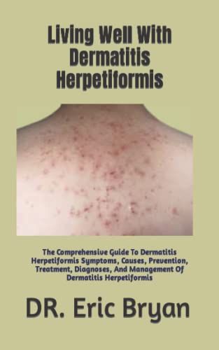 Living Well With Dermatitis Herpetiformis: The Comprehensive Guide To ...