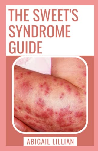 The Sweet's Syndrome Guide: The Complete Guide To Treatment, Causes And ...