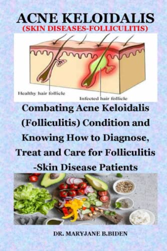 ACNE KELOIDALIS (SKIN DISEASES-FOLLICULITIS): Combating Acne Keloidalis ...