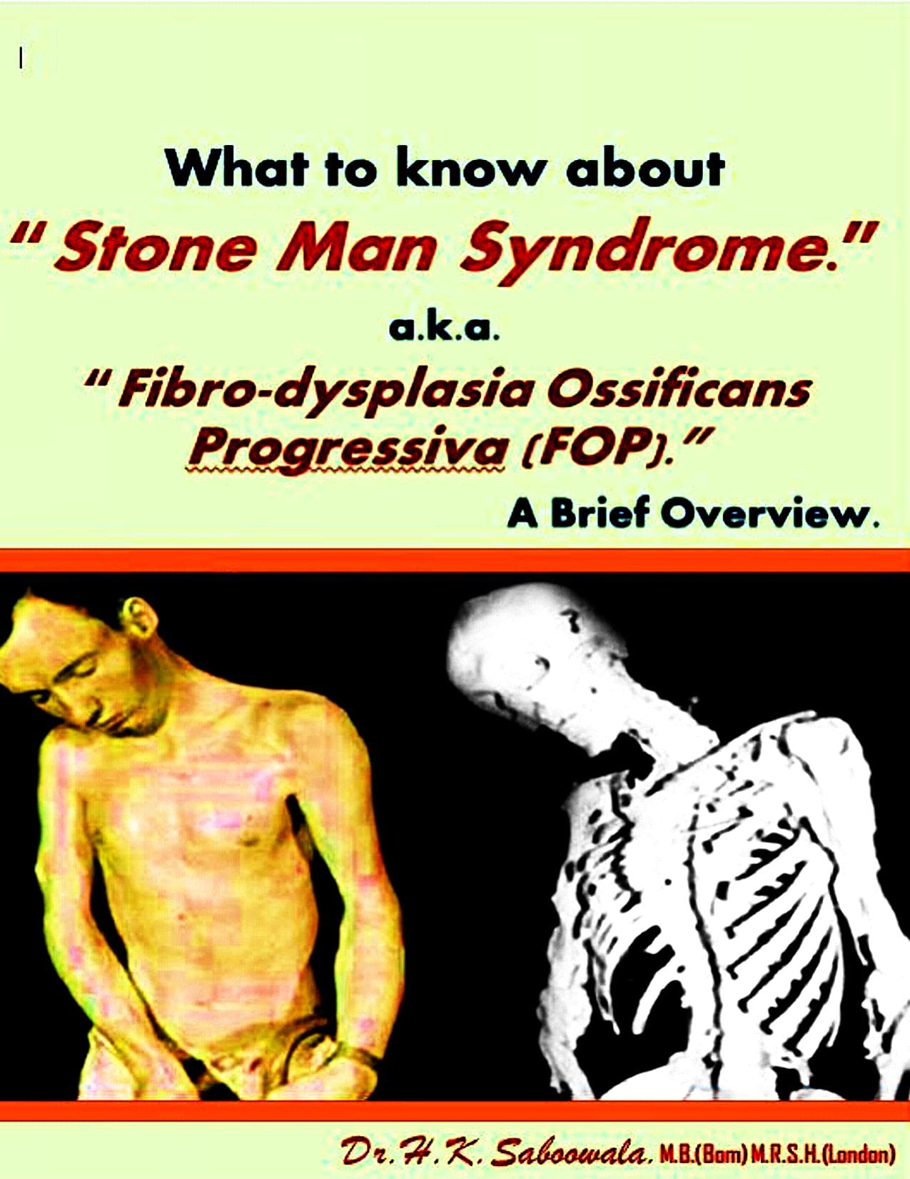 What to know about “Stone Man Syndrome.” a.k.a. “Fibrodysplasia ...