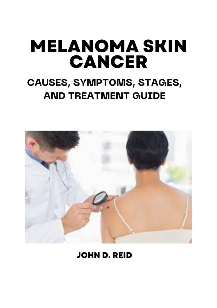 MELANOMA SKIN CANCER: CAUSES, SYMPTOMS, STAGES, AND TREATMENT GUIDE) by ...