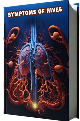 Symptoms of Hives: Recognize the symptoms of hives, also known as ...