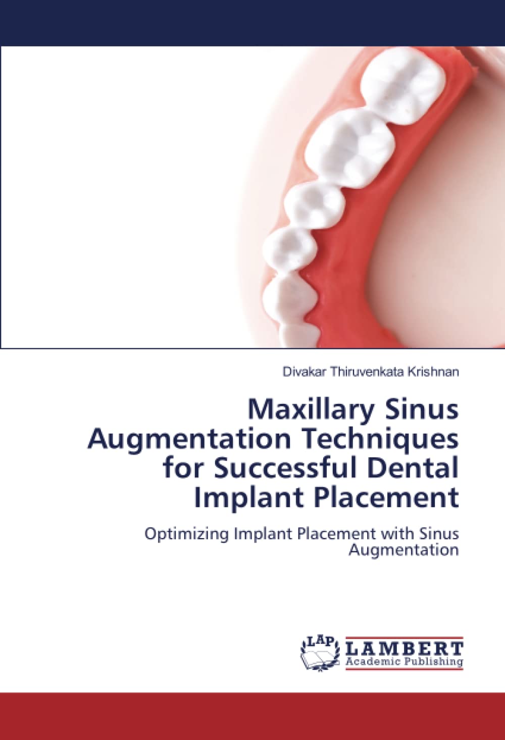 Maxillary Sinus Augmentation Techniques for Successful Dental Implant ...