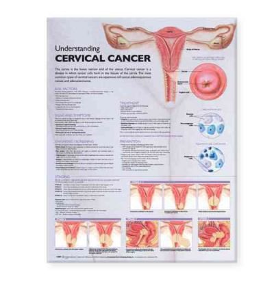 [(Understanding Cervical Cancer Anatomical Chart)] [Author: Anatomical ...