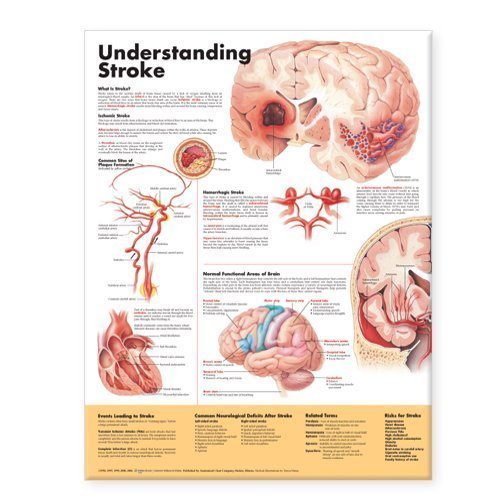 Understanding Stroke Anatomical Chart 2nd (second) Edition by ...
