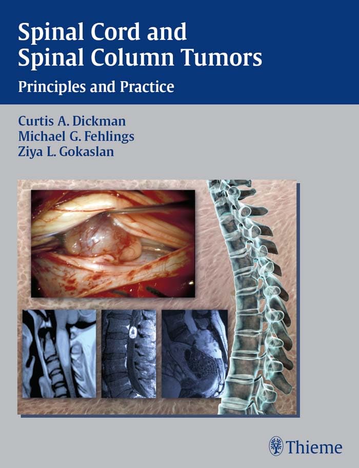 Spinal Cord and Spinal Column Tumors: Principles and Practice by Curtis ...