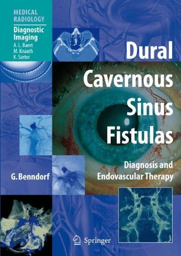 Dural Cavernous Sinus Fistulas: Diagnosis and Endovascular Therapy (Medical Radiology) by Goetz ...