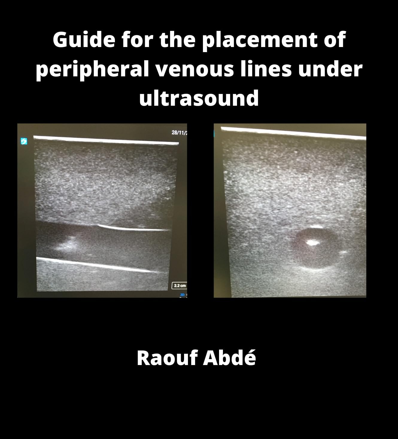 Guide for the placement of peripheral venous lines under ultrasound by ...