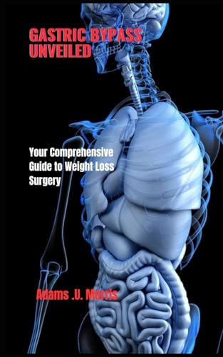 Gastric Bypass Unveiled: Your Comprehensive Guide to Weight Loss ...