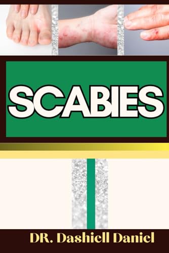 SCABIES: Expert Guide To Understanding Scabies Causes, Symptoms ...