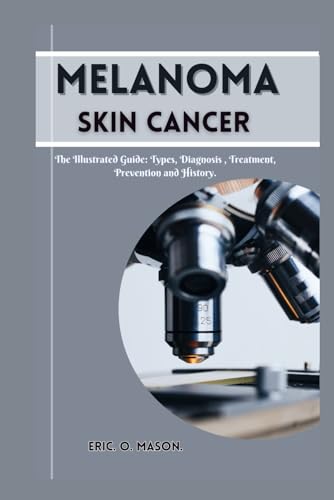 MELANOMA SKIN CANCER: The illustrated Guide : Types Diagnosis Treatment ...