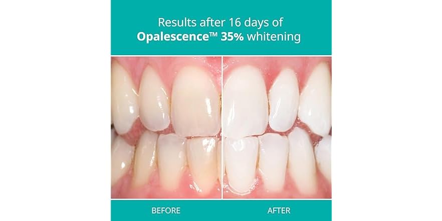 (4 Pack) Opalescence 35% Gel Syringes Teeth Whitening - Refill Kit
