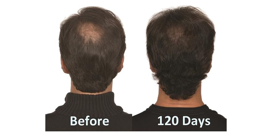 iGrow Laser Hair Growth System