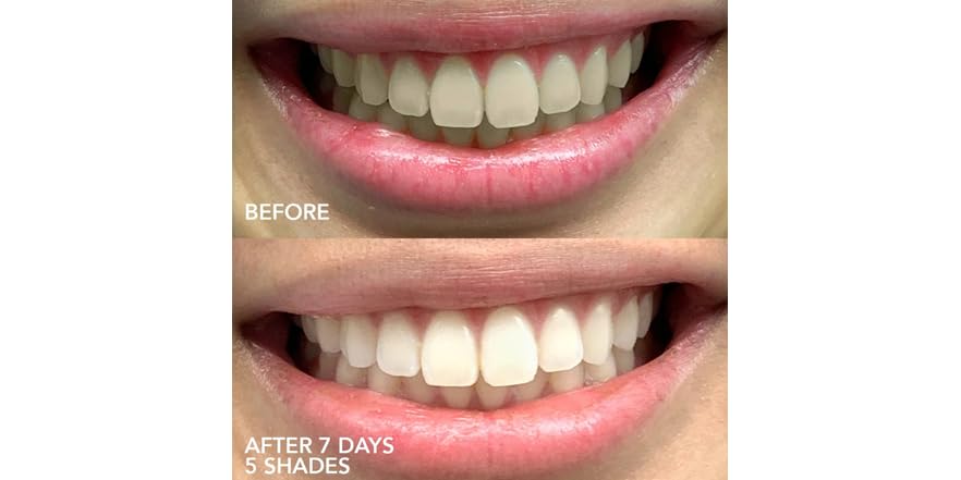 Glo Teeth Whitening Device Kit with Bluetooth