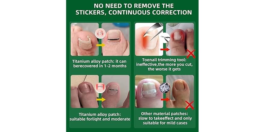 Titanium Alloy Ingrown Toenail Treatment