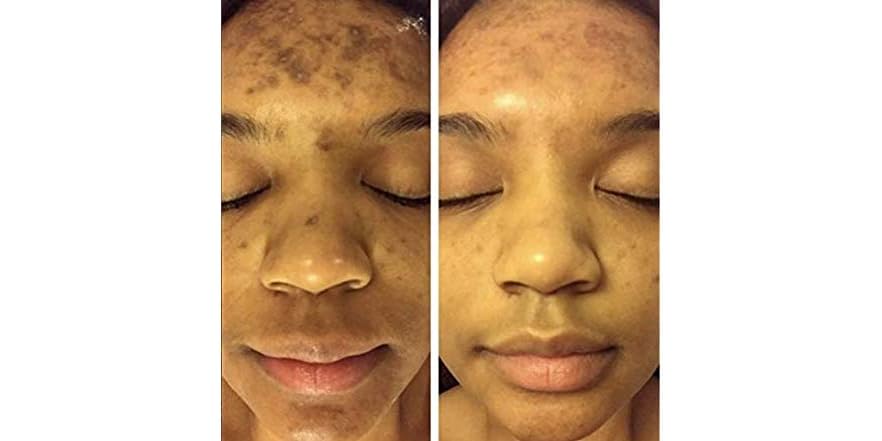 Hydroquinone Dark Spot Corrector Remover