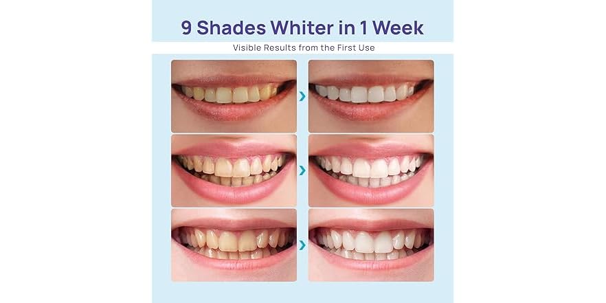 Whitebite Pro teeth whitening kit