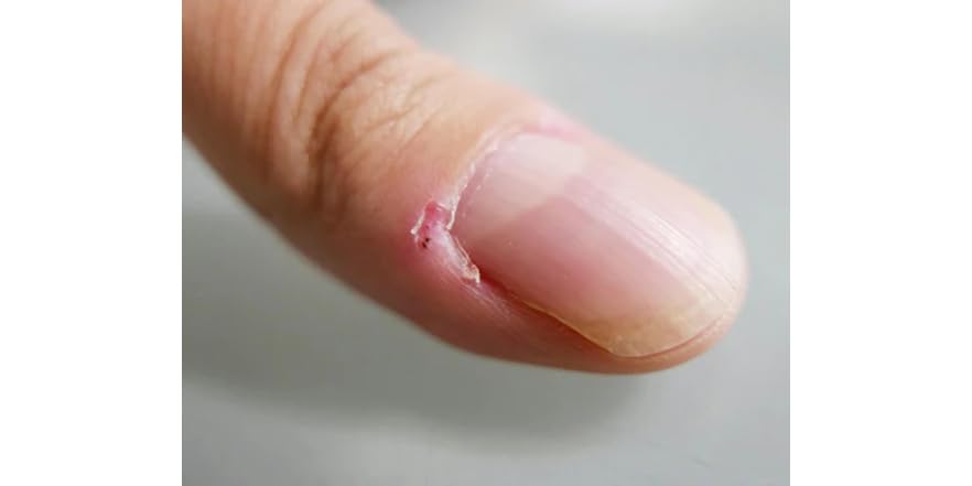 Bite Our Cuticles