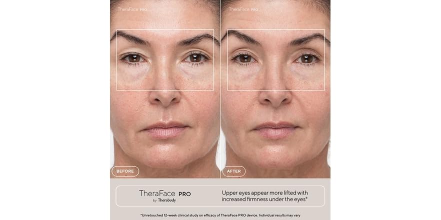 TheraFace PRO Microcurrent Facial Device