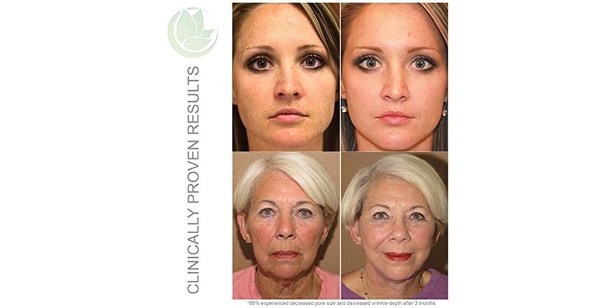 Microderm GLO Diamond Microdermabrasion Machine