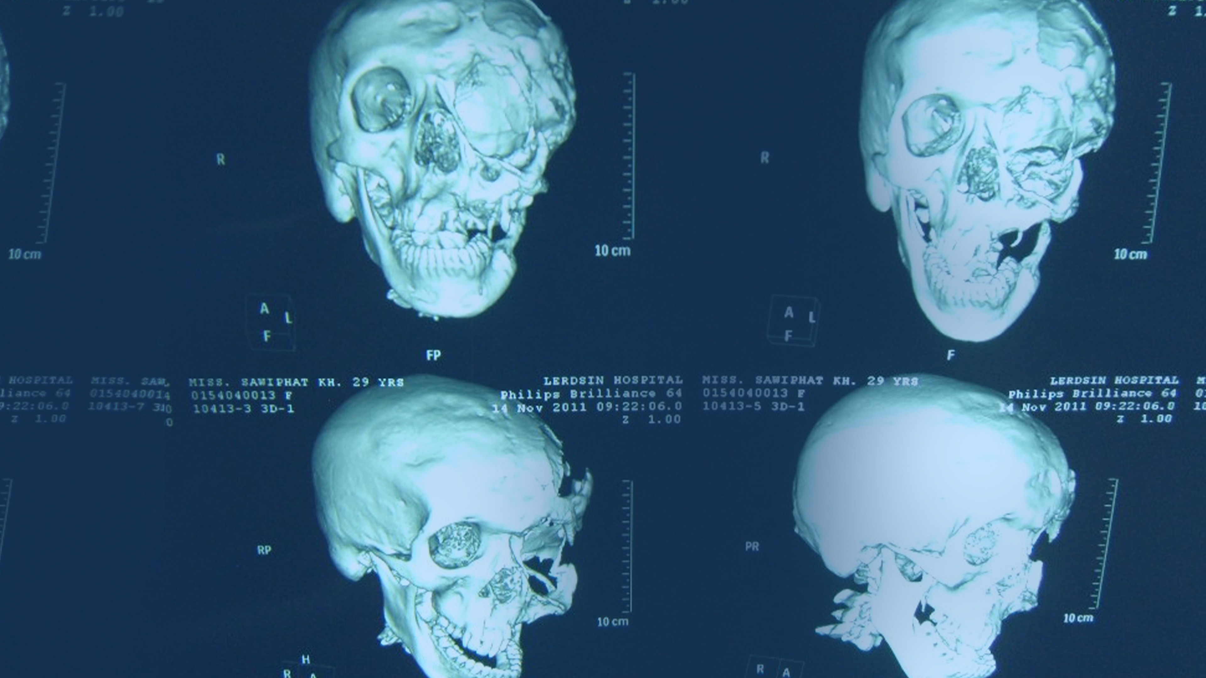 Prime Video: My Giant Face Tumor - Season 1